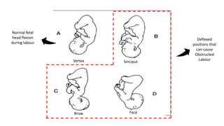 Obstructed Labour.pptx