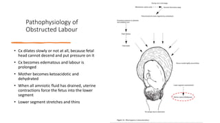 Obstructed Labour.pptx