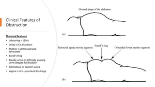 Obstructed Labour.pptx