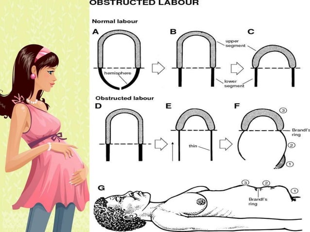 obstructed labour.pptx