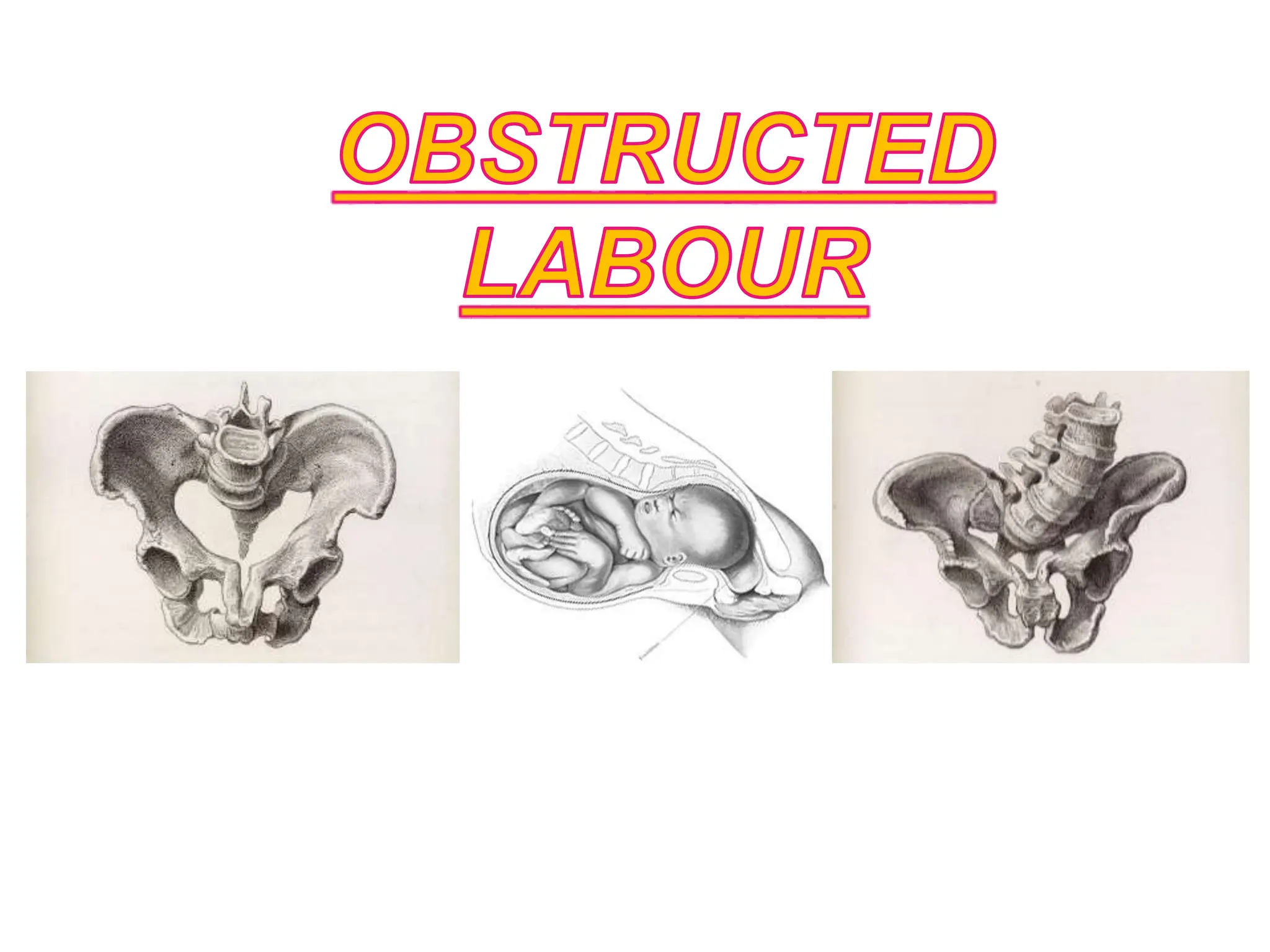 Obstructed Labor and Management in Obstetrics | PPTX