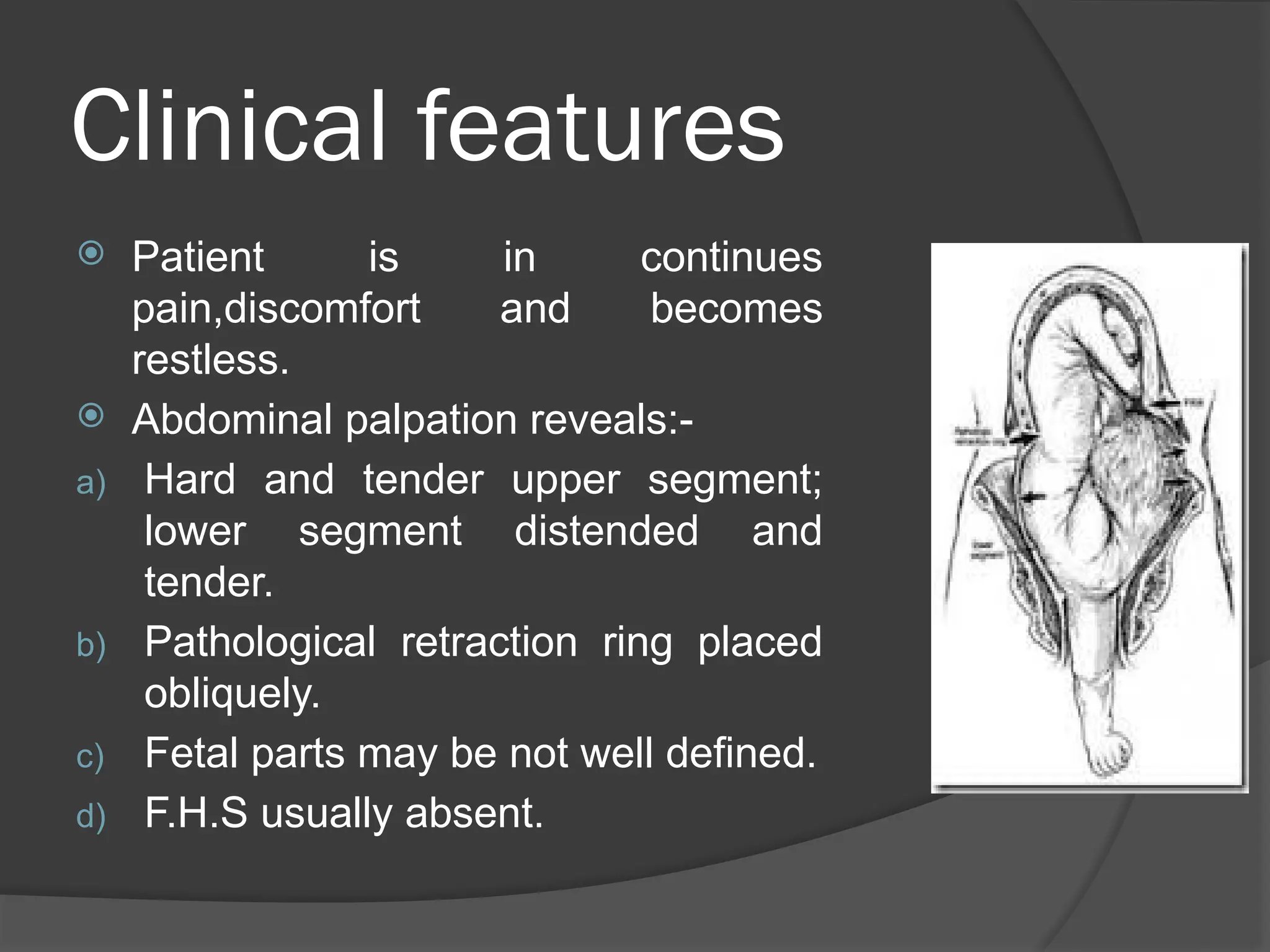 ppt on obstructed labour and its management . | PPTX