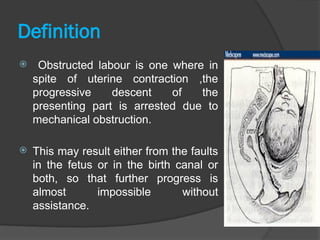 ppt on obstructed labour and its management . | PPT