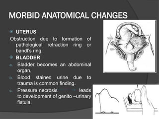 ppt on obstructed labour and its management . | PPT