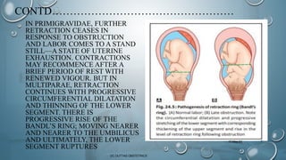 OBSTRUCTED LABOUR -EBM.pdf