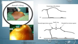 OBSTRUCTED LABOUR -EBM.pdf