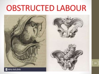 Obstructed labour and Prolonged Labour | PPTX