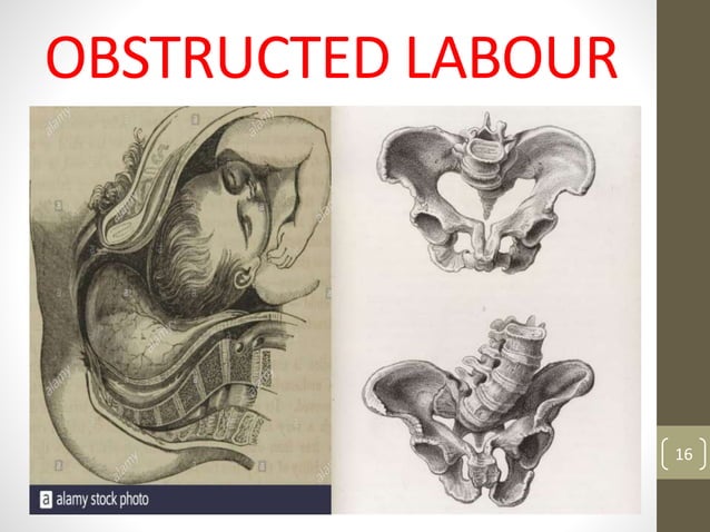 Obstructed labour and Prolonged Labour | PPTX