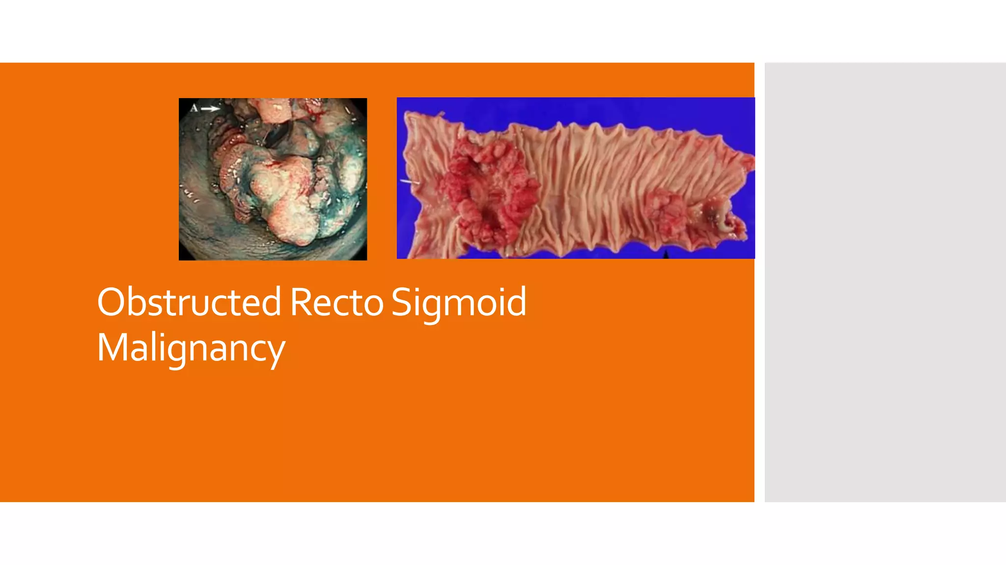 Obstructed recto sigmoid malignancy | PPTX
