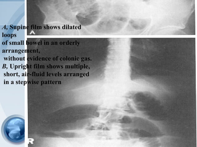 Intestinal obstruction management final.ppt