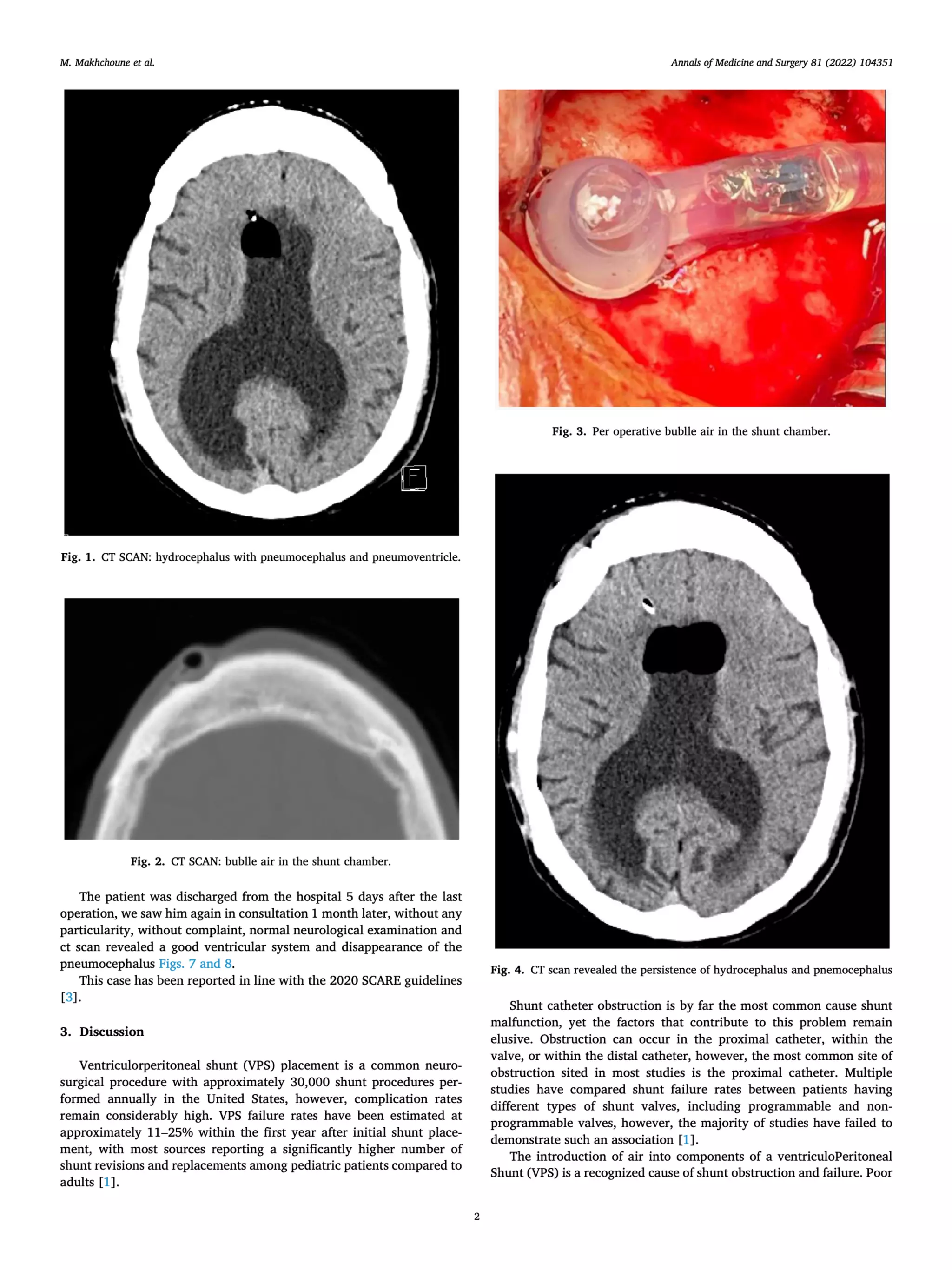 Obstruction of ventriculoperitoneal shunt by air bubble | PDF