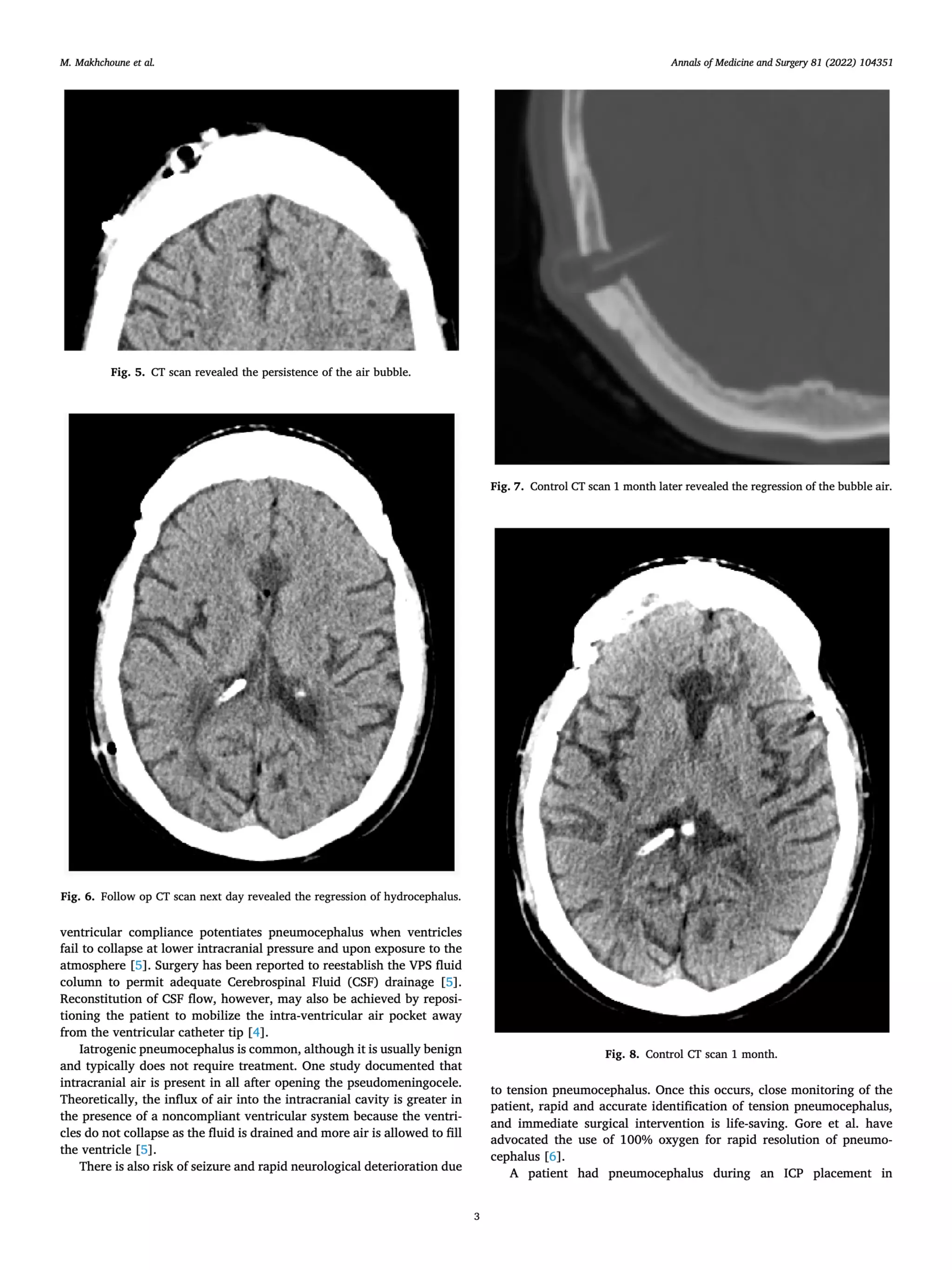 Obstruction of ventriculoperitoneal shunt by air bubble | PDF