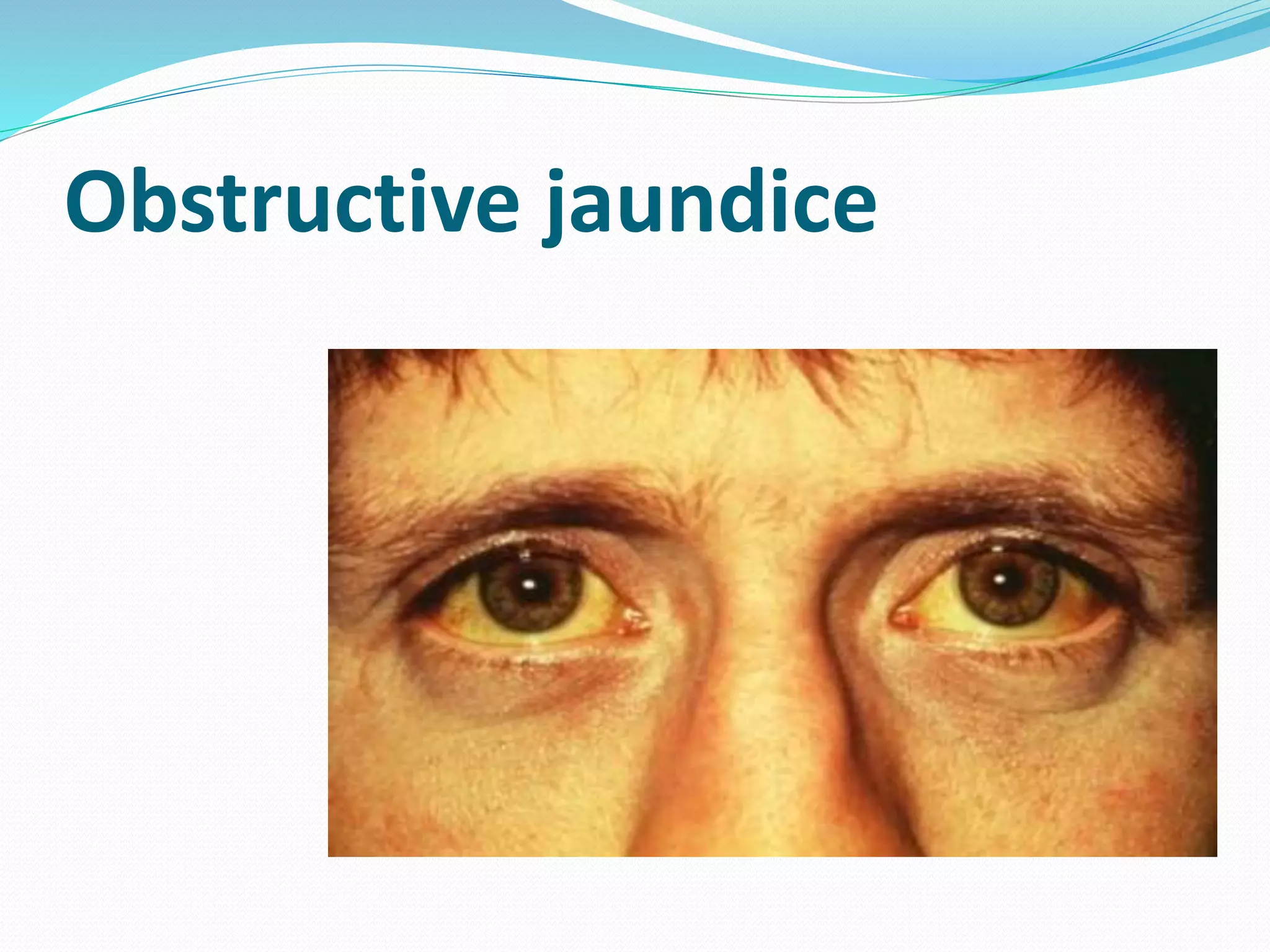 Obstructive Jaudice seminar.pptx