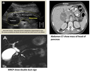 Obstructive jaundice | PPTX