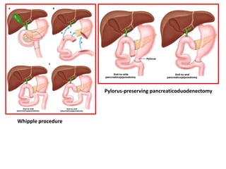 Obstructive jaundice | PPTX