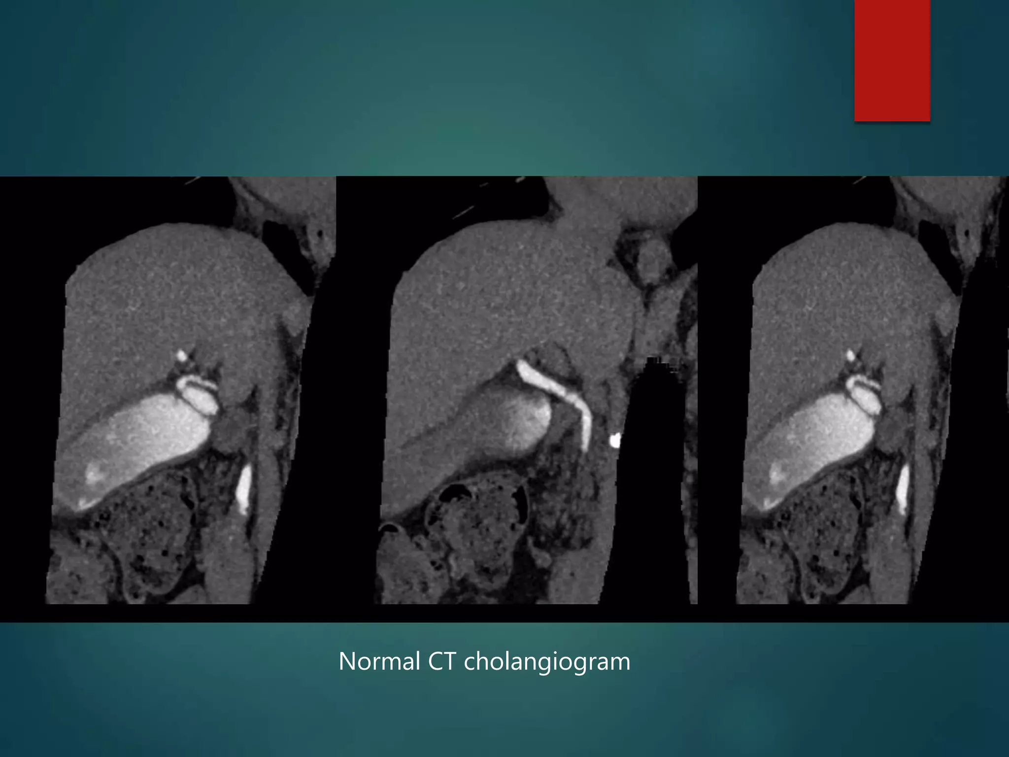Imaging of Obstructive jaundice | PPTX