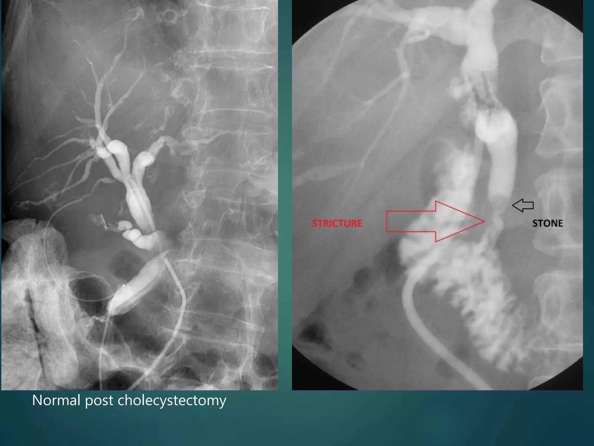 Imaging of Obstructive jaundice | PPTX