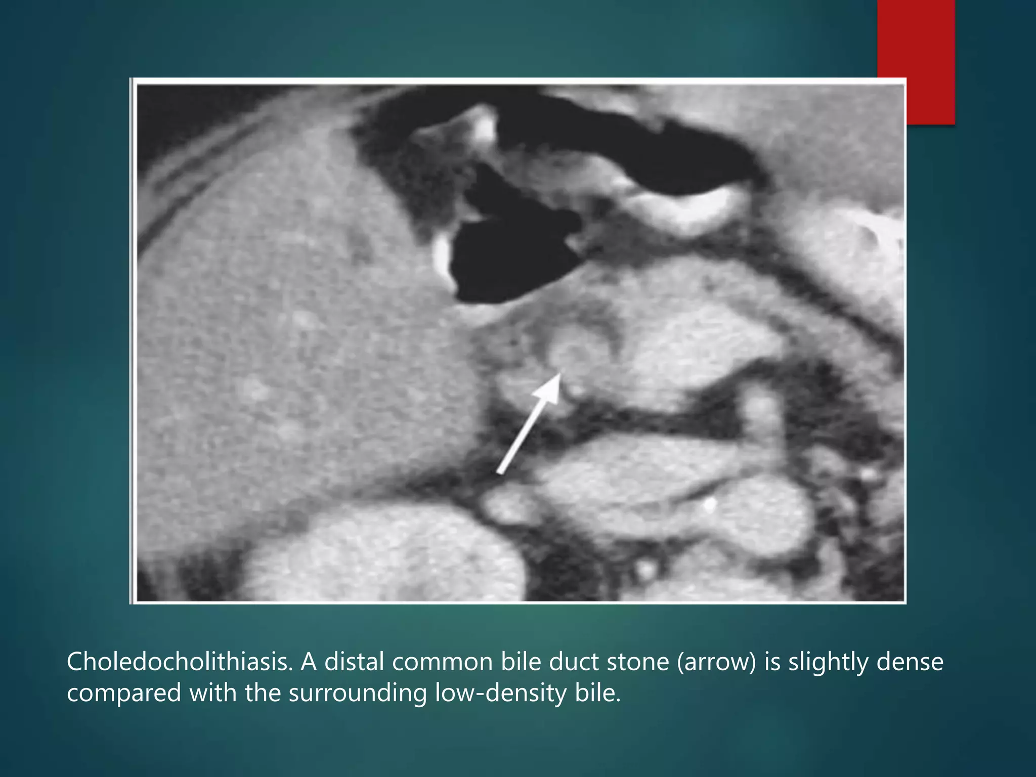 Imaging of Obstructive jaundice | PPTX