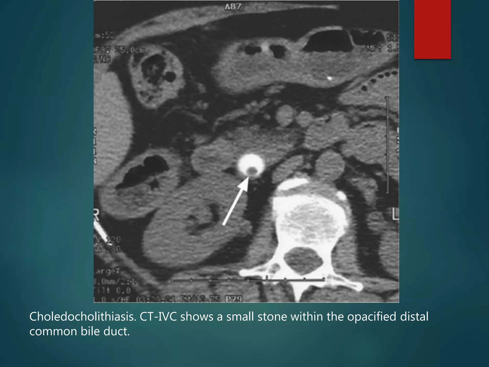 Imaging of Obstructive jaundice | PPTX