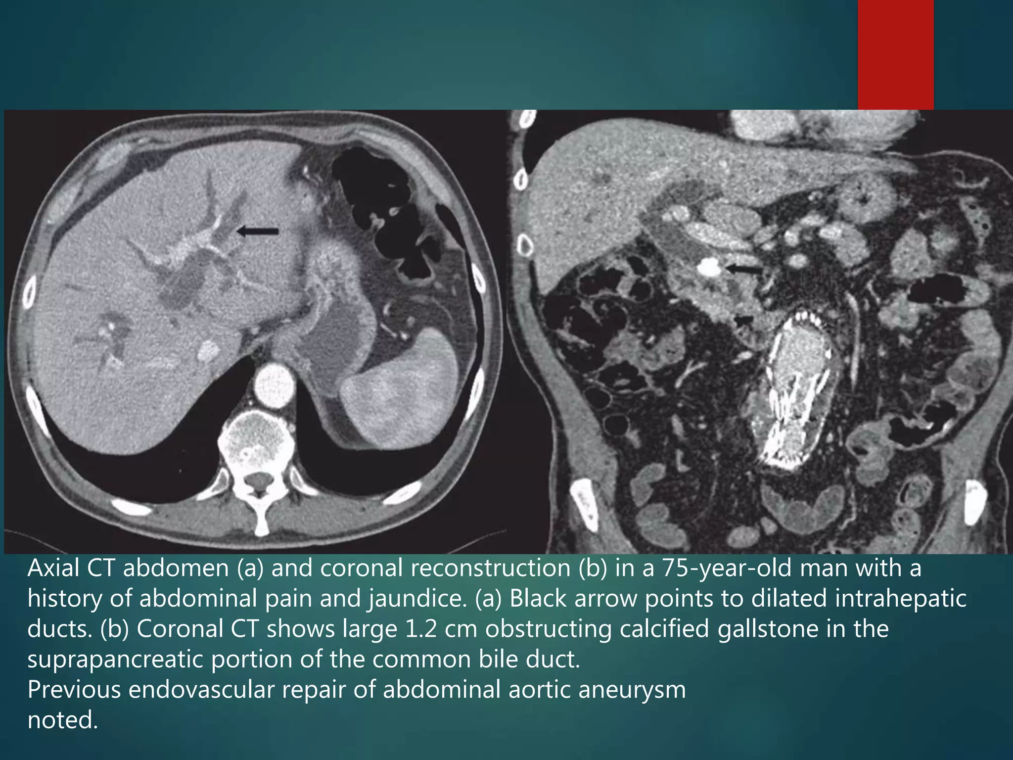 Imaging of Obstructive jaundice | PPTX