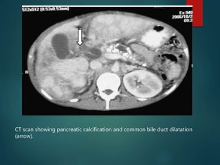 Imaging of Obstructive jaundice | PPTX