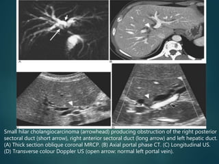 Imaging of Obstructive jaundice | PPTX