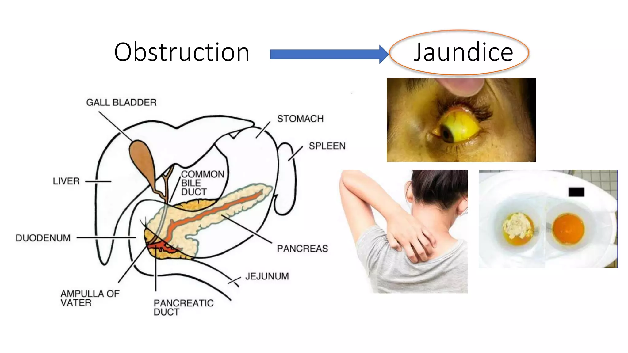 obstructive jaundice.pptx