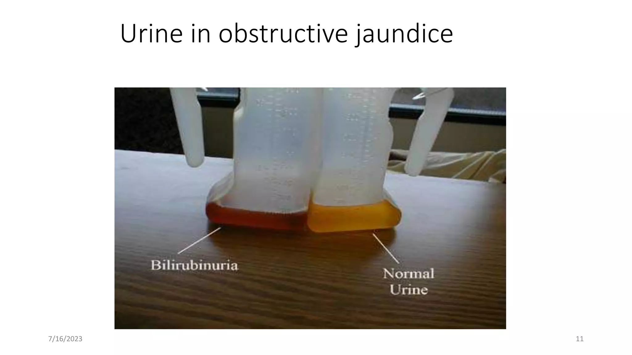 Obstructive jaundice.pptx
