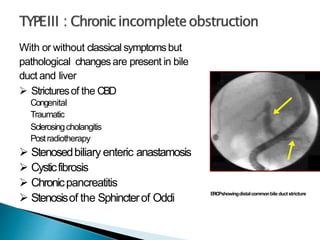 Obstructive Jaundice- General Surgery notes | PPTX