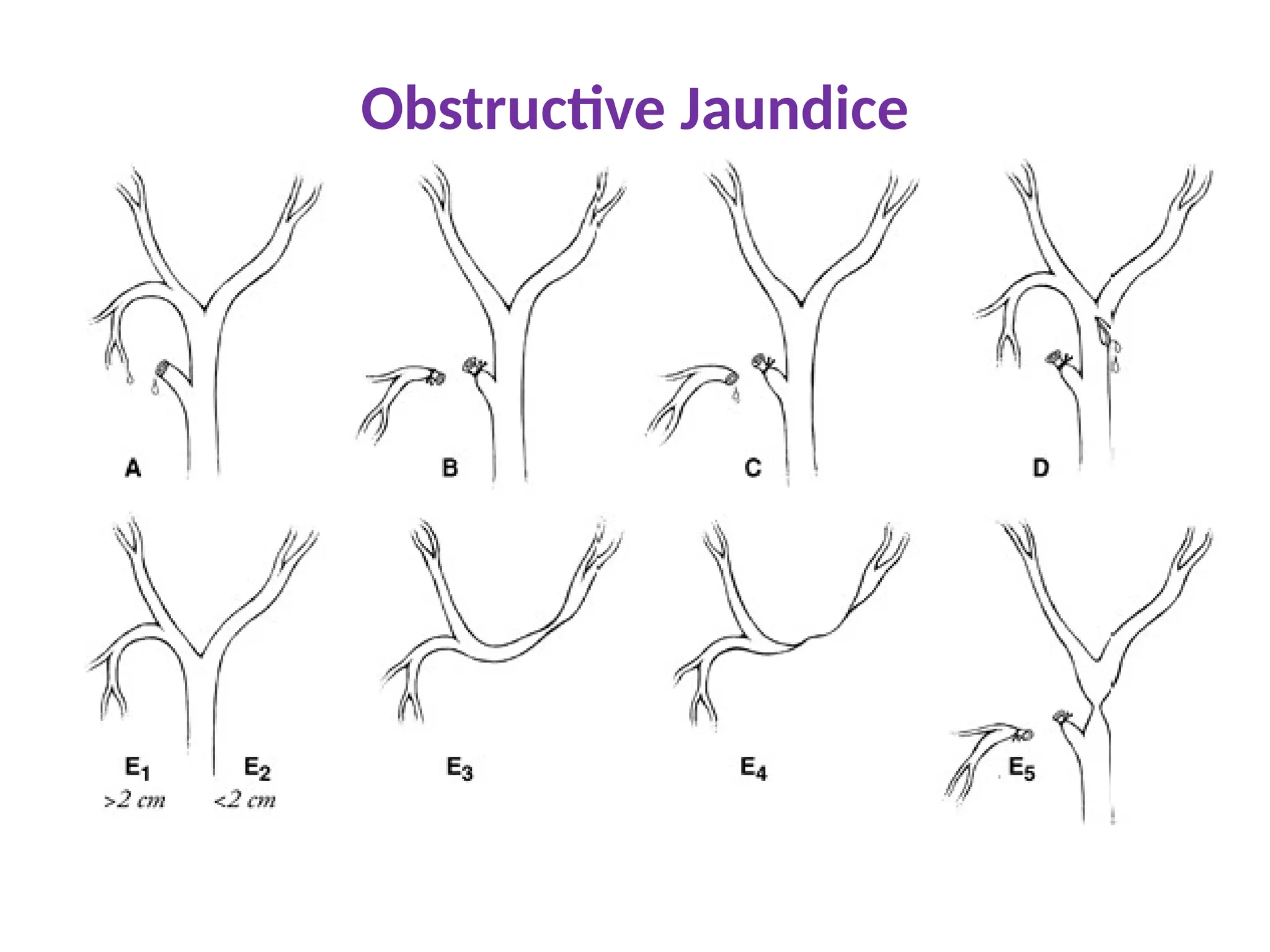 Causes of obstructive jaundice in surgical patients | PPT