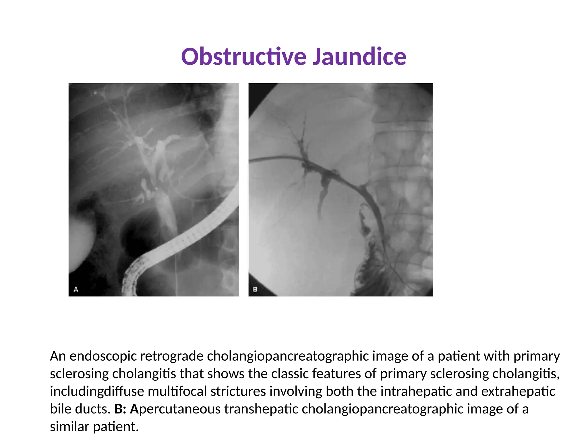 Causes of obstructive jaundice in surgical patients | PPT