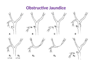 Causes of obstructive jaundice in surgical patients | PPTX