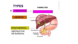 Obstructive jaundice or post hepatic jaundice | PPTX