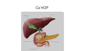 Obstructive jaundice or post hepatic jaundice | PPTX