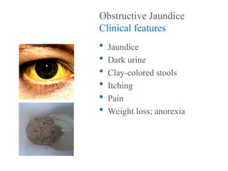 Obstructive Jaundice, causes, investigations.ppt