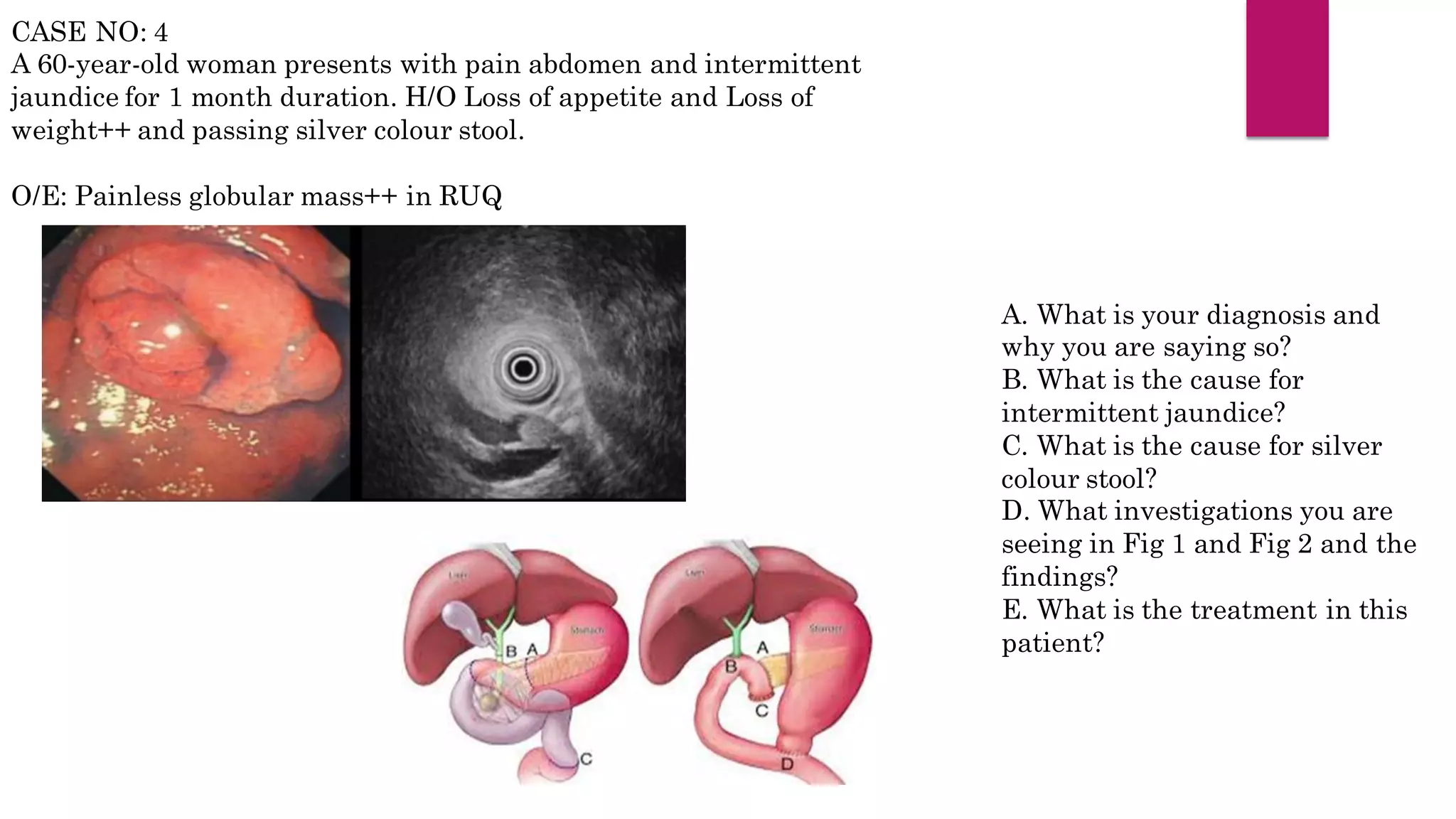 Obstructive jaundice/ Problem Based Learning/ clinical case scenario ...