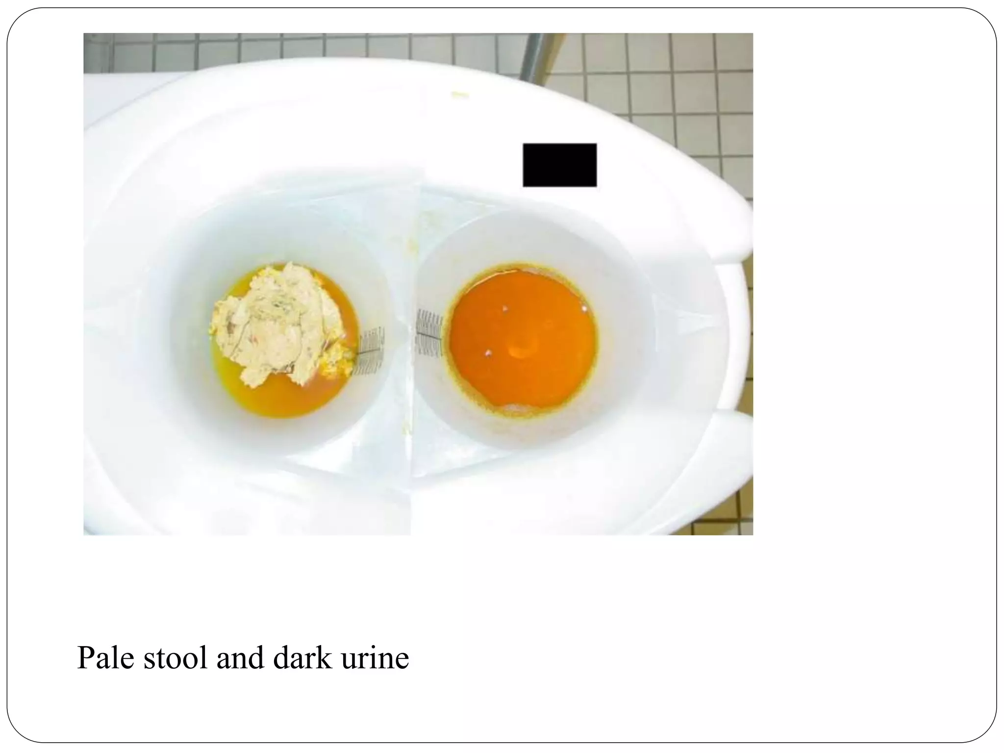 Obstructive jaundice 1 | PPTX