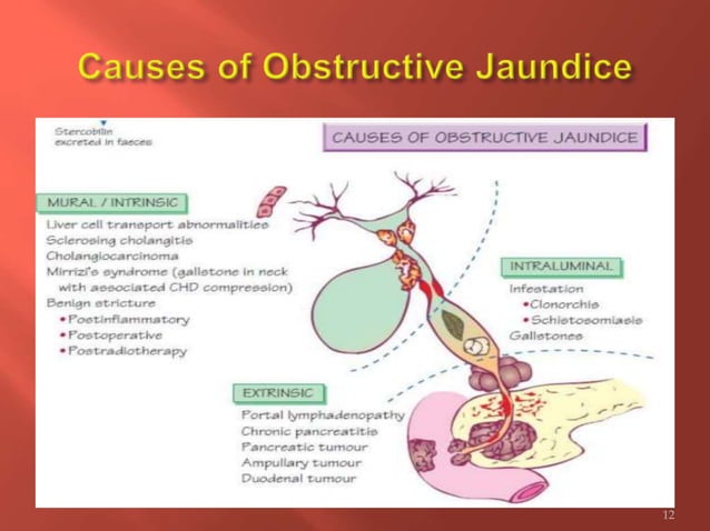 Obstructive jaundice (final year mbbs lecture ) | PPTX | Digestive ...