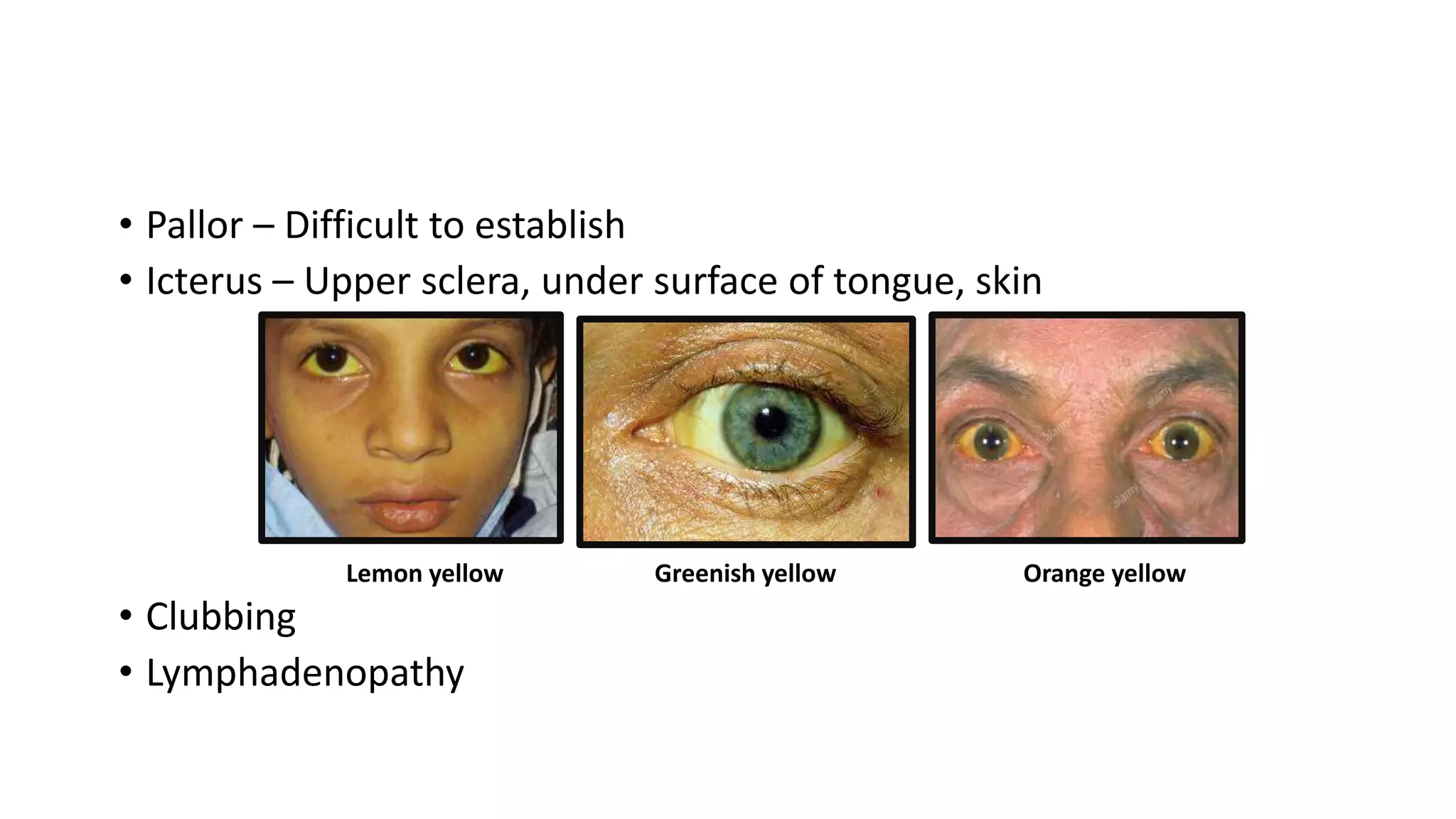 Obstructive Jaundice presentaion harsh.pptx