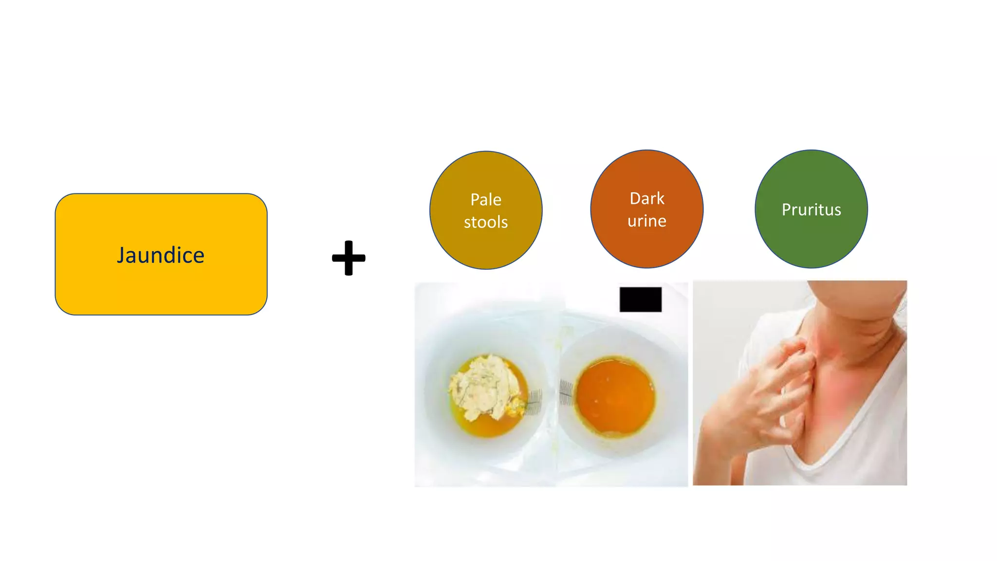 Obstructive Jaundice presentaion harsh.pptx