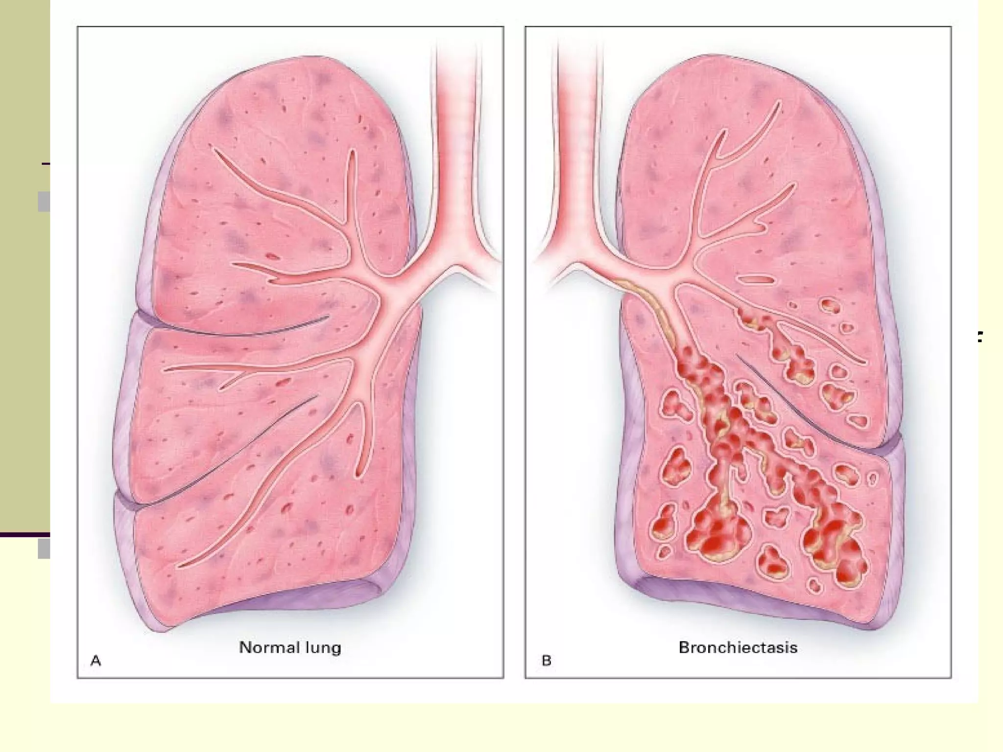 Obstructive lung disease | PPT