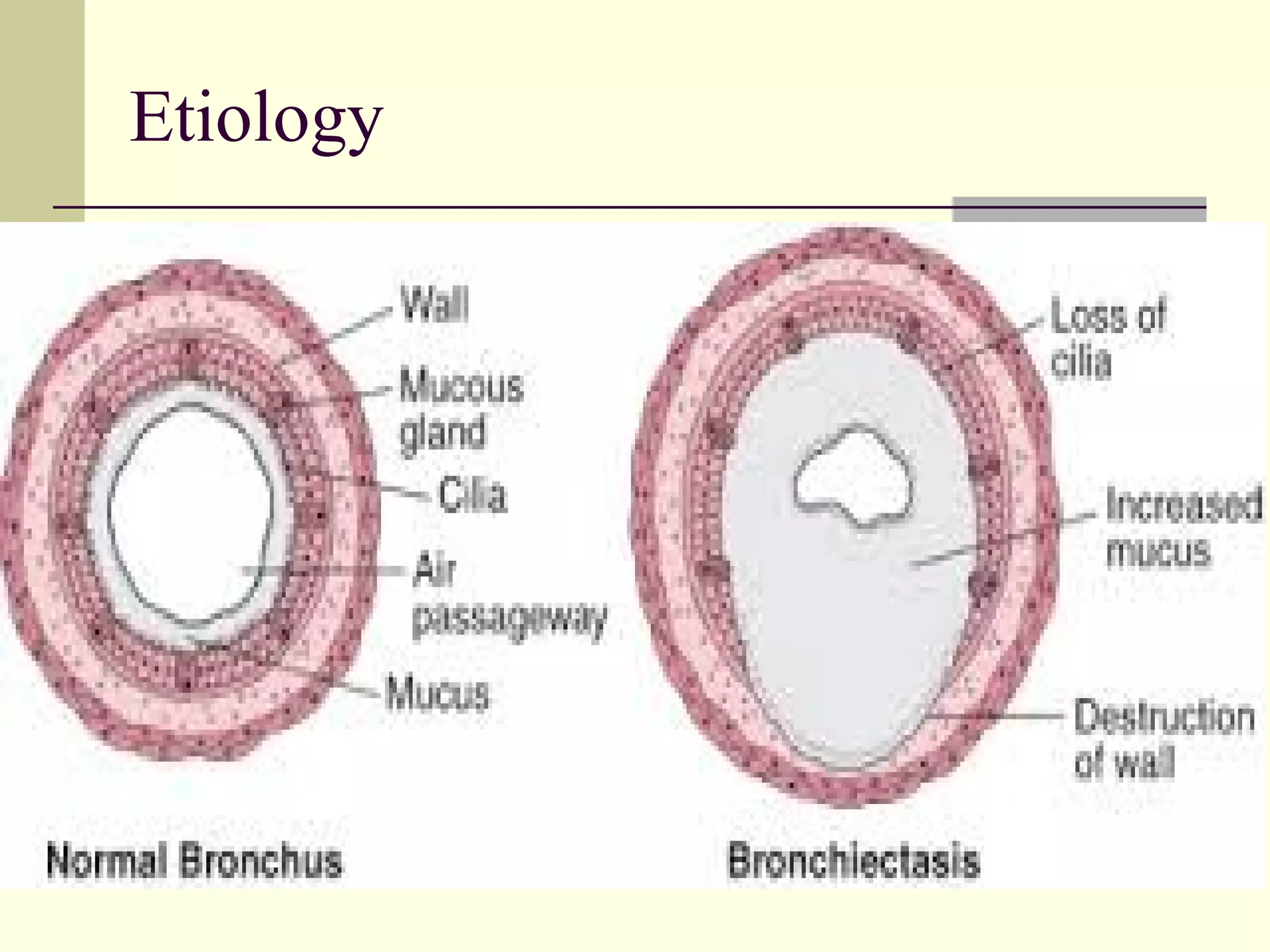 Obstructive lung disease | PPT