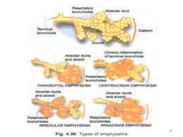 Obstructive Lung Diseases