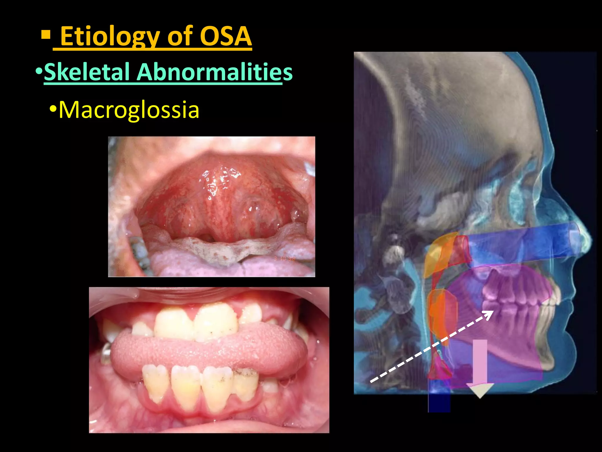 Obstructive sleep apnea | PDF