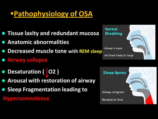 Obstructive sleep apnea | PDF