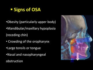 Obstructive sleep apnea | PDF