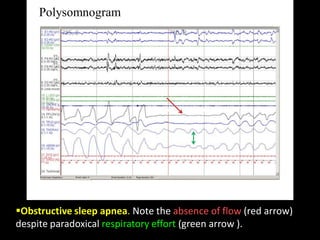 Obstructive sleep apnea | PDF