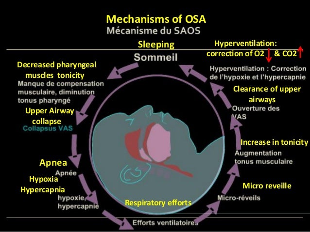 Obstructive sleep apnea