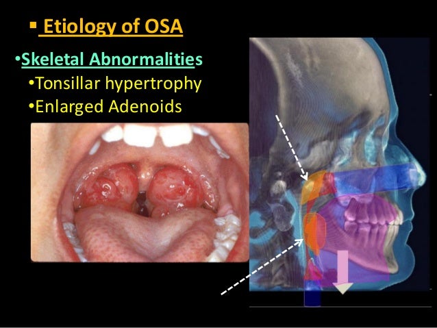 Obstructive sleep apnea