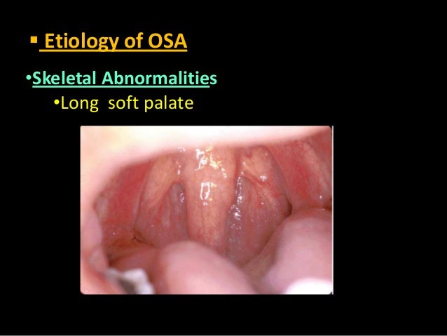 Obstructive sleep apnea